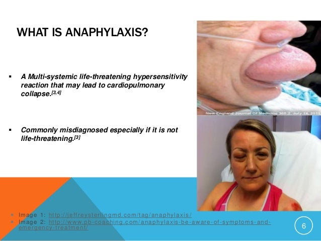 Resuscitation techniques in anaphylaxis