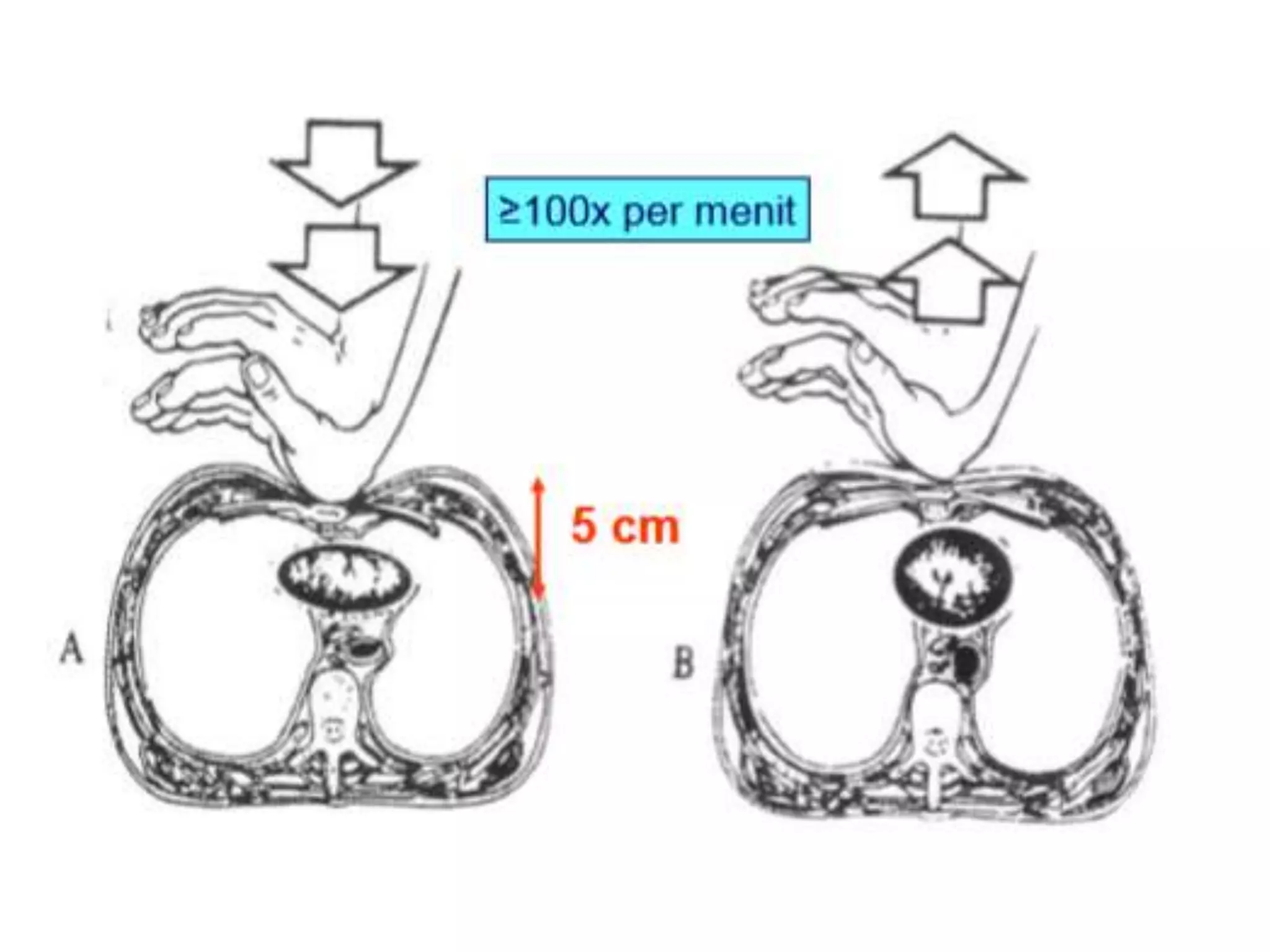 Resusitasi jantung paru otak | PPTX