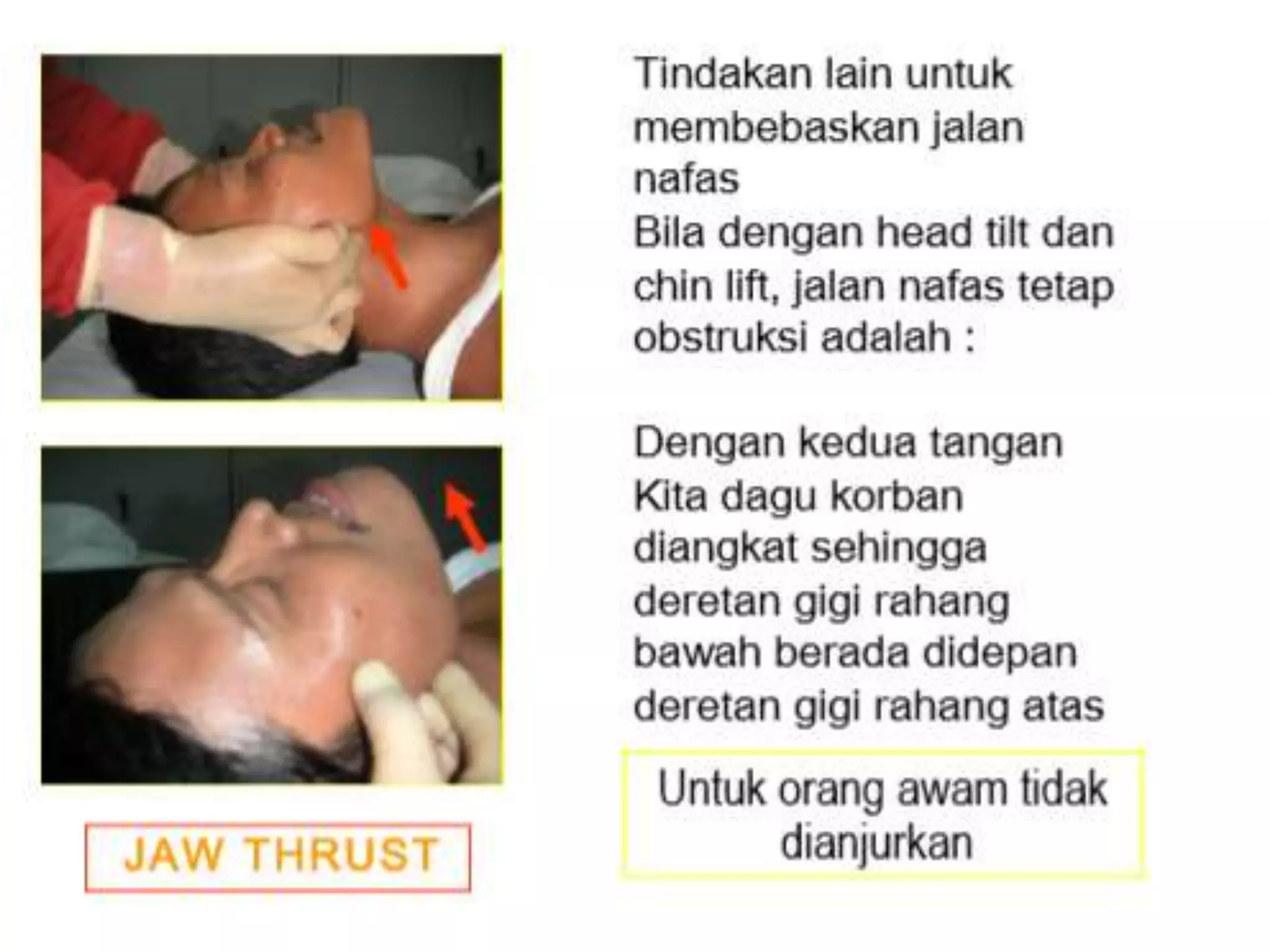 Resusitasi jantung paru otak | PPTX