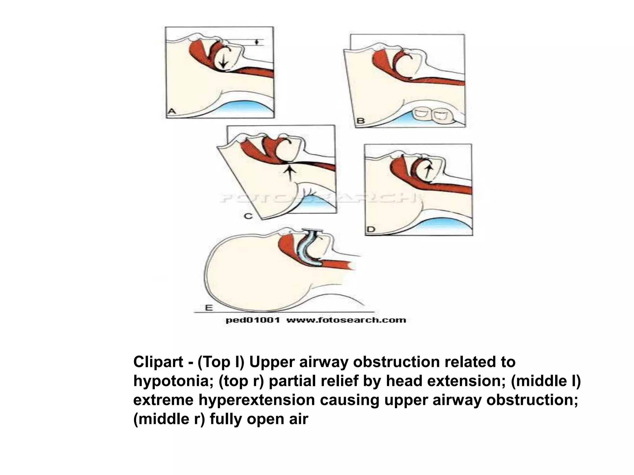 RESUSITASI JANTUNG PARU (RJP).ppt
