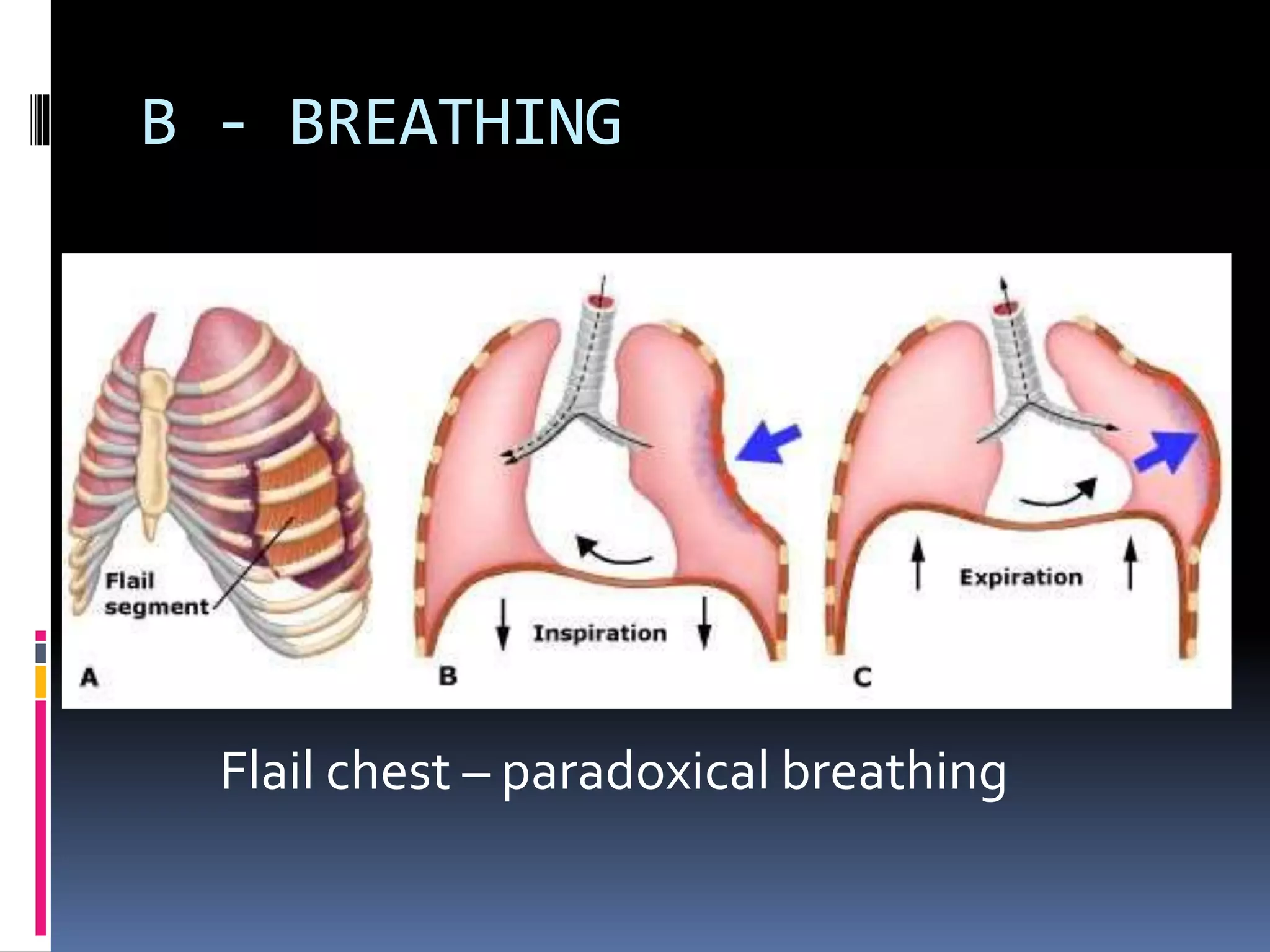 Resus & primary mx of trauma | PPT