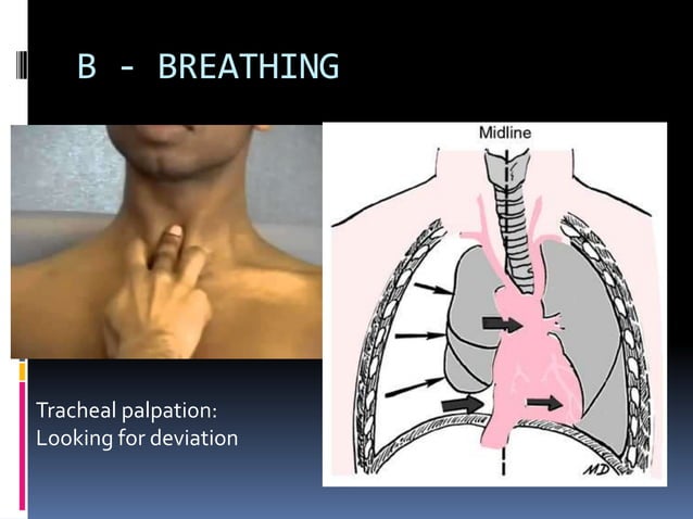 Resus & primary mx of trauma | PPT