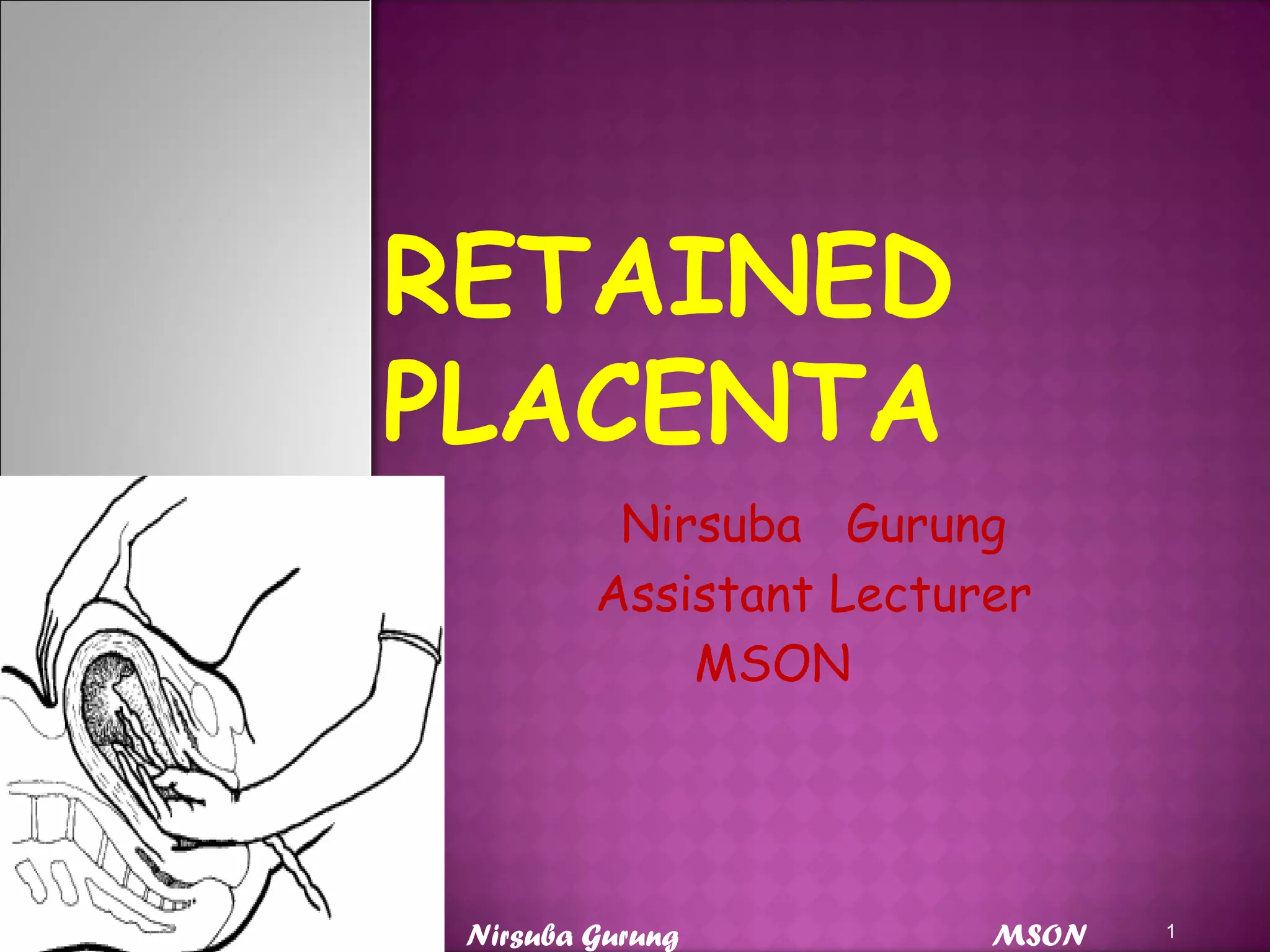 Retained placenta | PPT