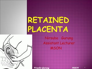 Retained Placental Fragments