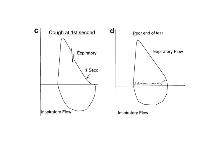 Spirometry Interpretation | PPT