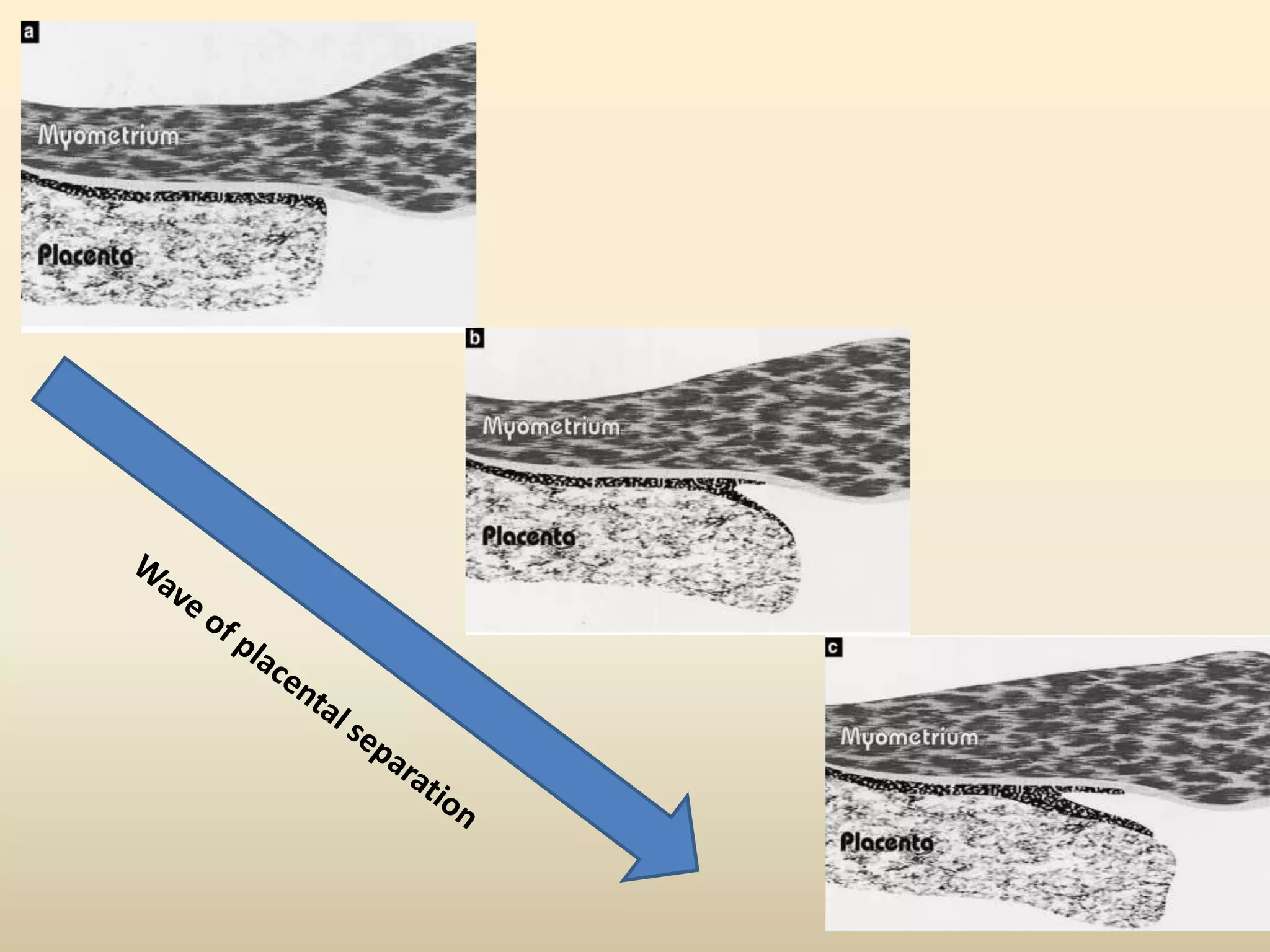 Retained placenta | PPTX