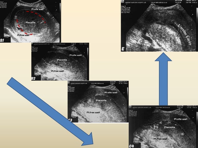 Retained placenta | PPTX | Pregnancy | Reproductive Health