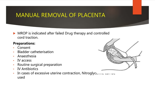 Retained placenta | PPTX | Pregnancy | Reproductive Health