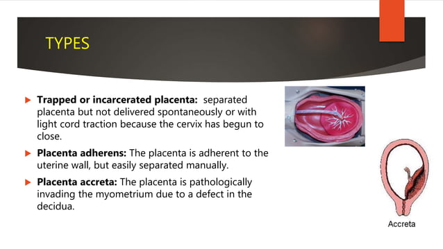 Retained placenta | PPTX | Pregnancy | Reproductive Health