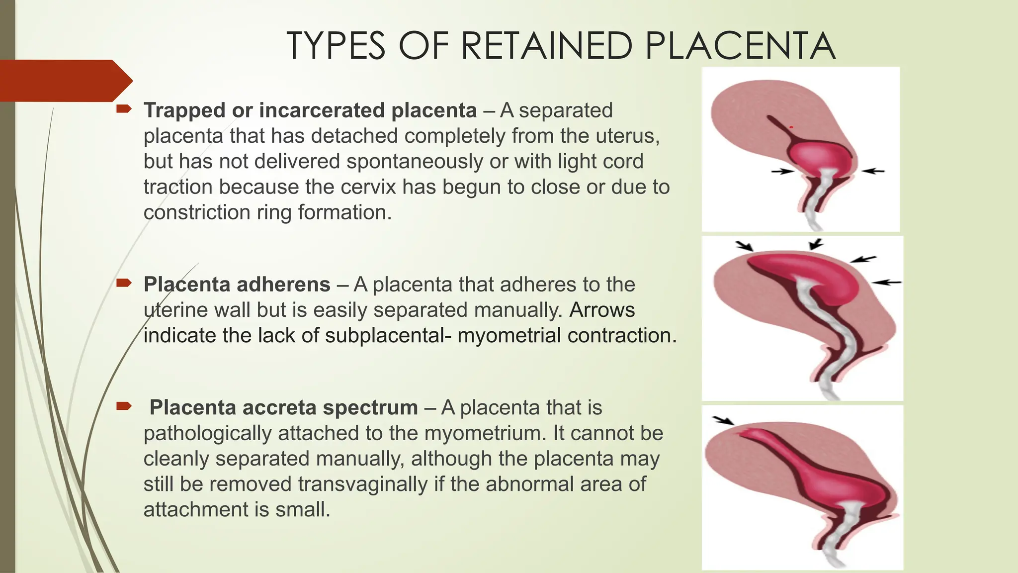 RETAINED PLACENTA - management and pptx | PPTX