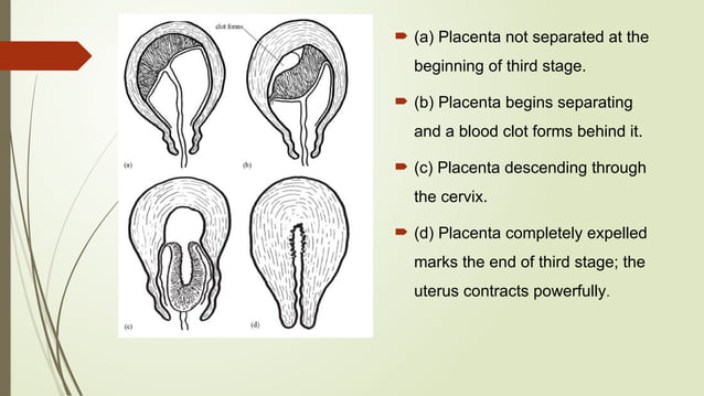 RETAINED PLACENTA - management and pptx | PPTX | Pregnancy ...