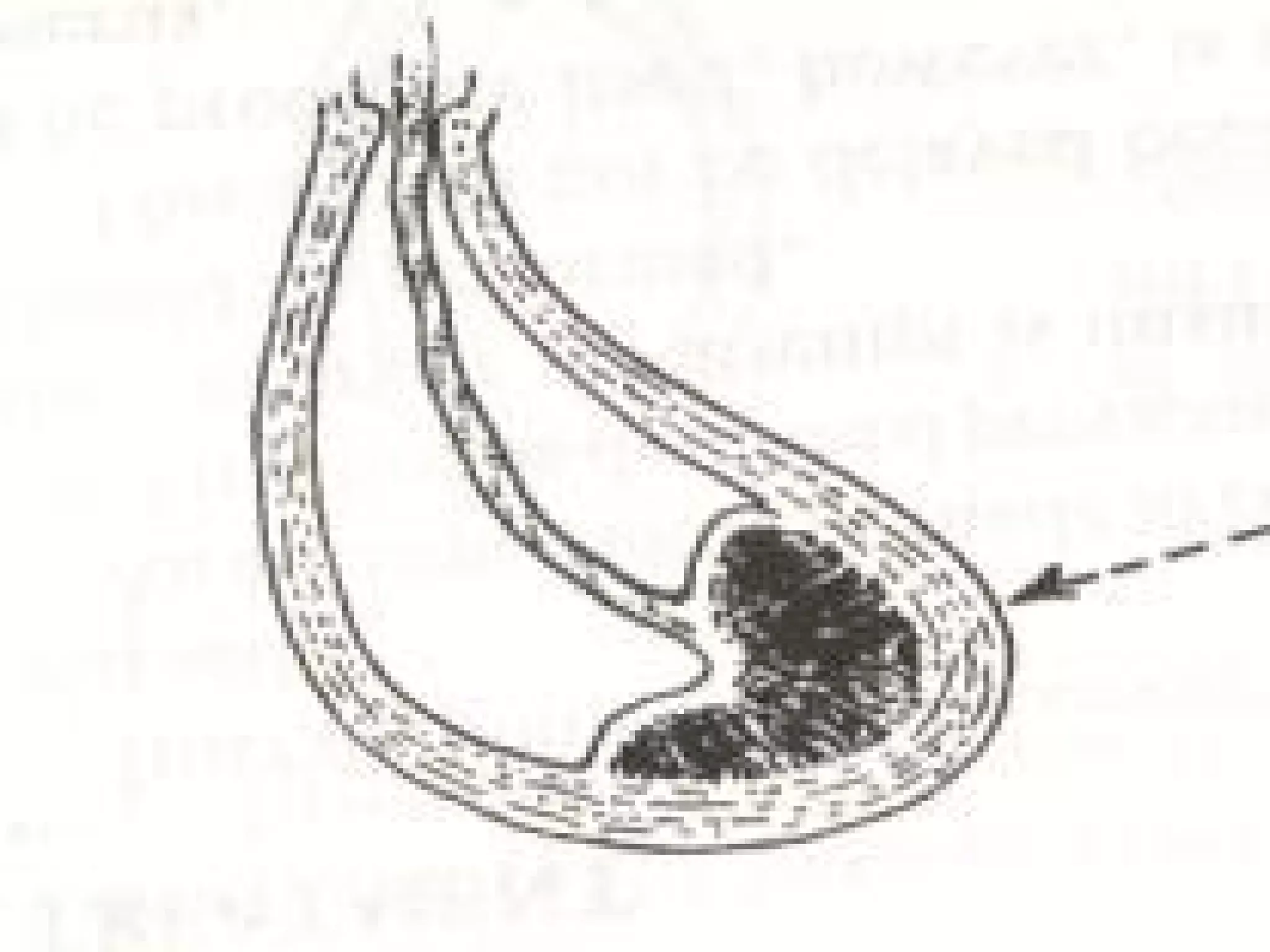 Retained Placenta - PLASENTA TERSEKAT | PPT