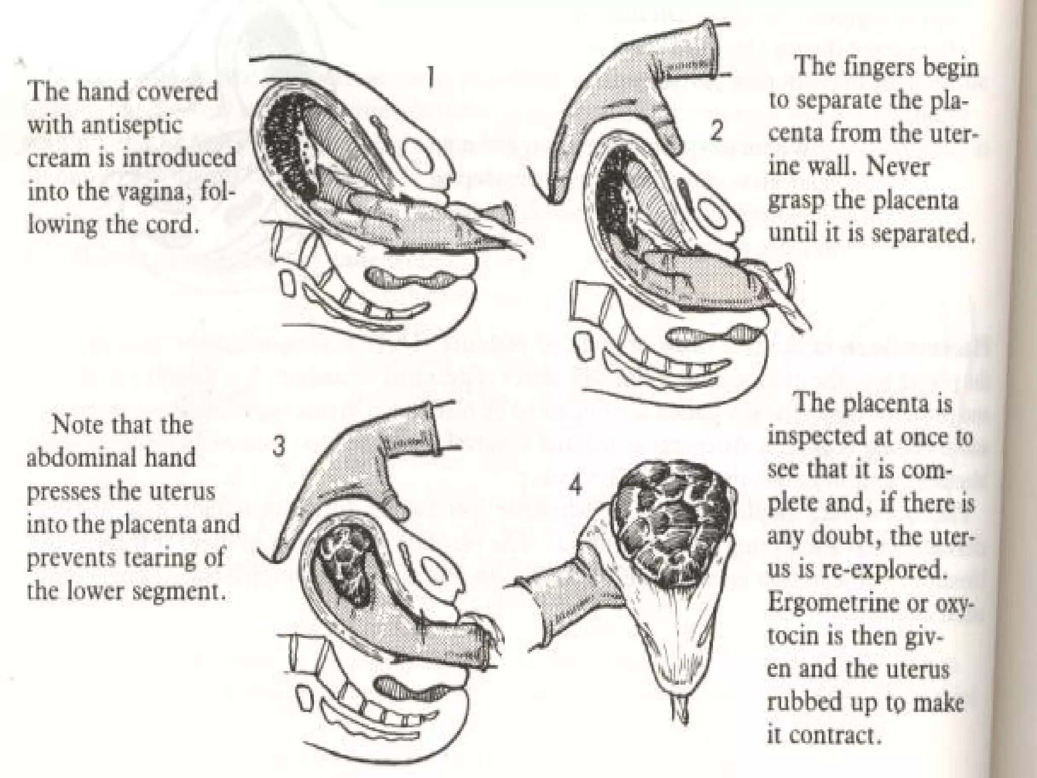 Retained Placenta - PLASENTA TERSEKAT | PPT