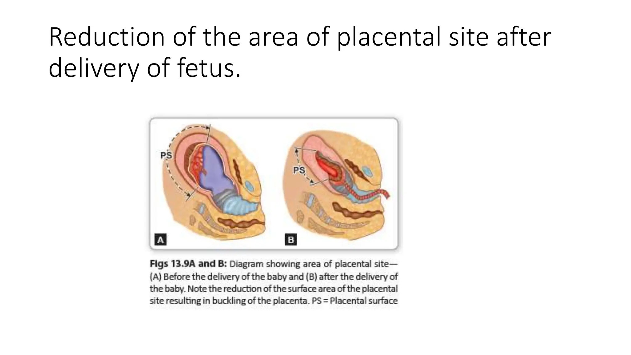 RETAINED PLACENTA AND HOW TO MANAGE IT.pptx