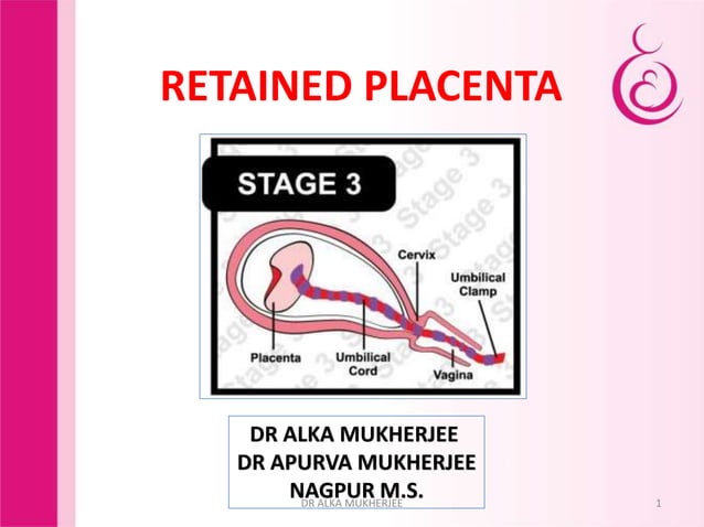 Retained placenta by dr alka mukherjee & dr apurva mukherjee | PPTX ...