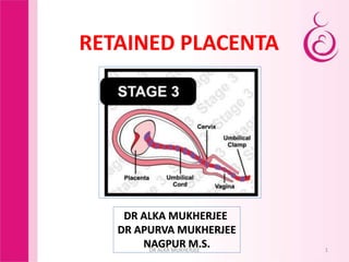 Retained Placental Fragments