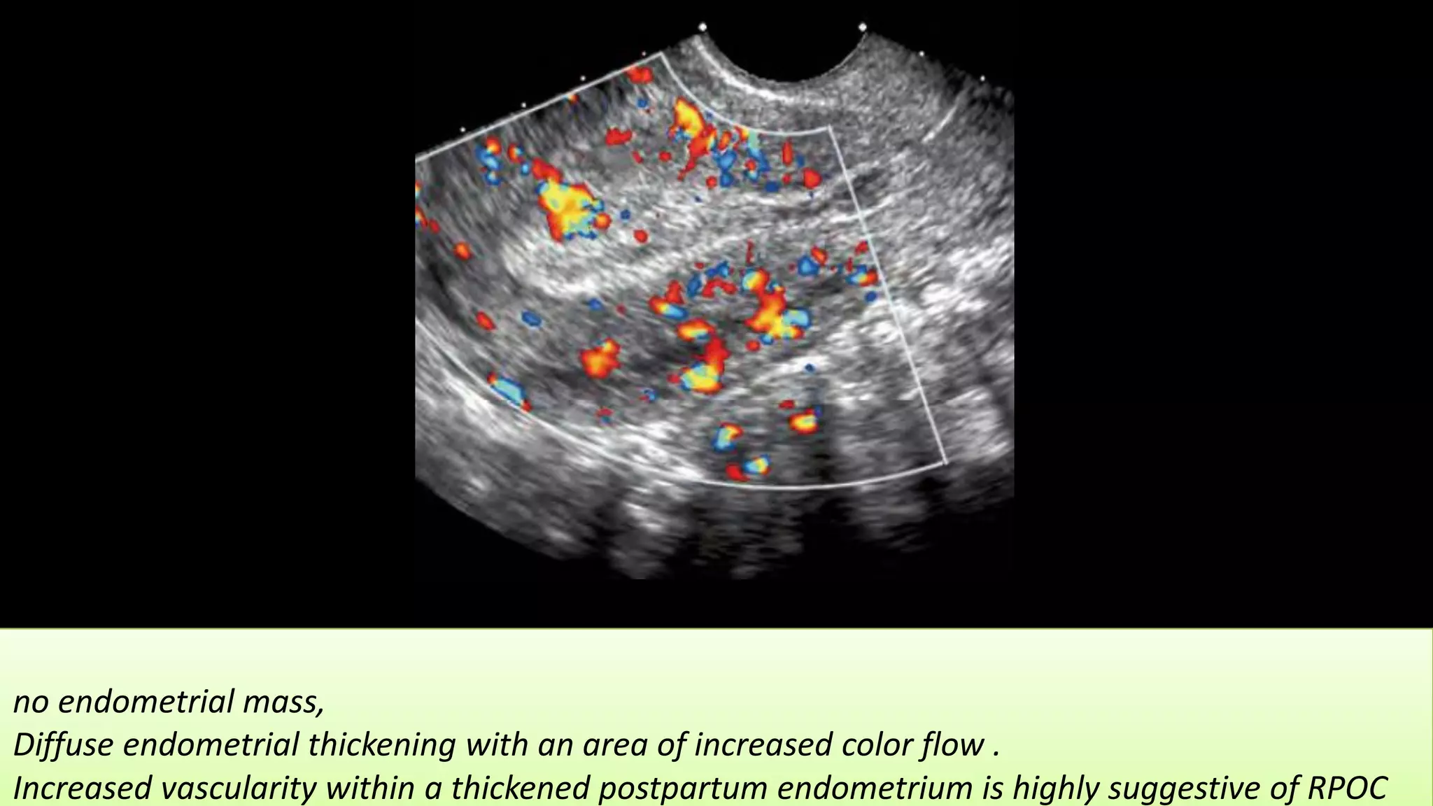 Retained Products Of Conception Drmohamed Soliman Ppt