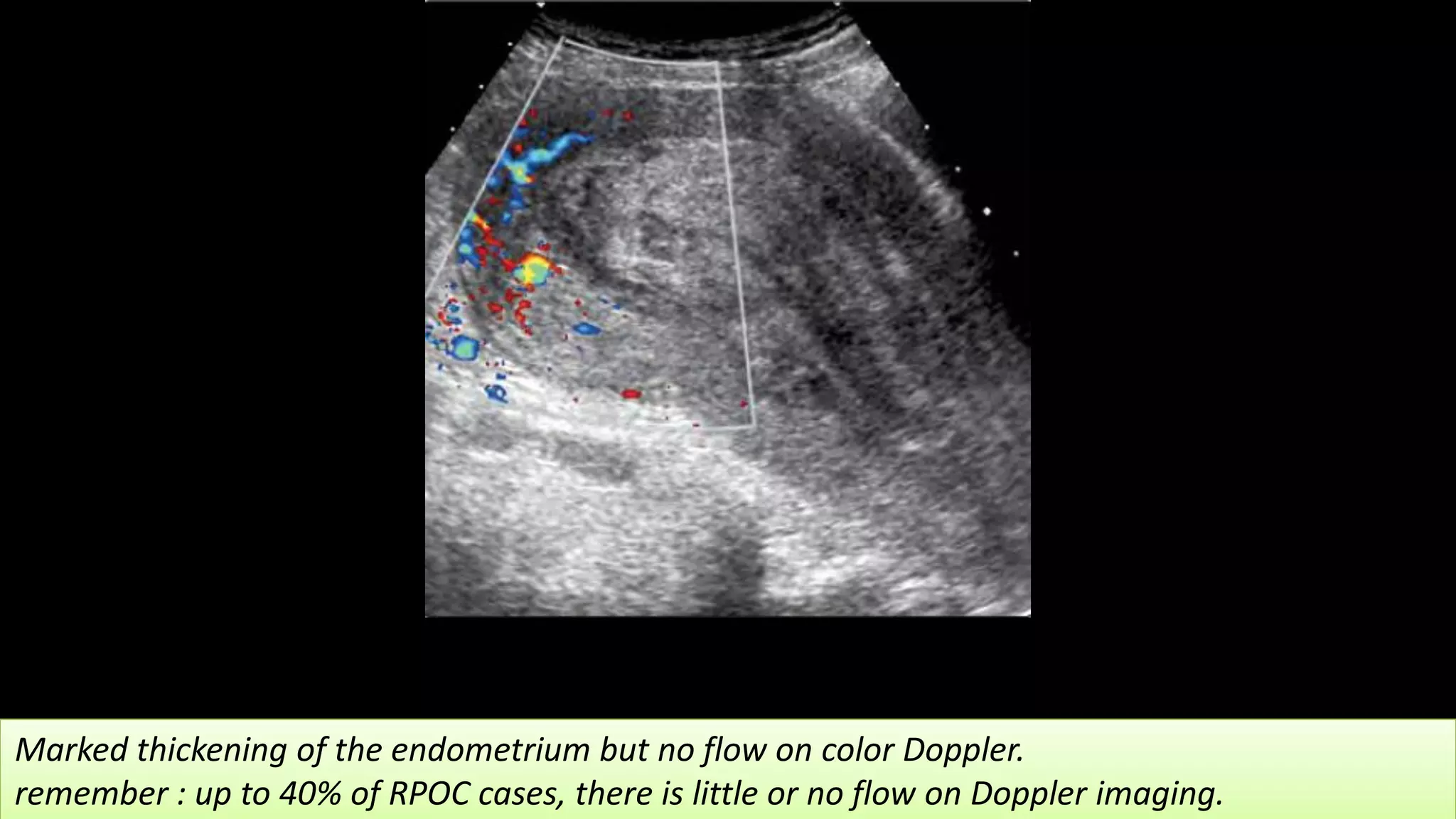 Retained products of conception dr.mohamed Soliman | PDF