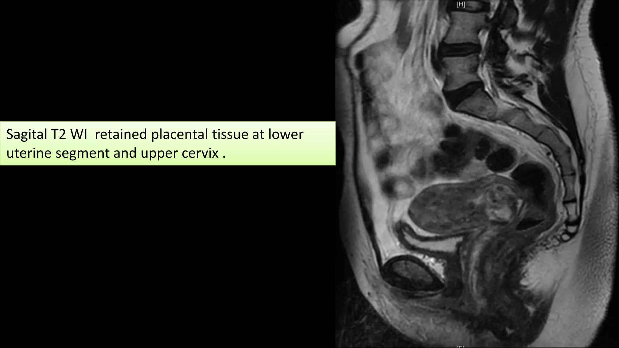 Retained products of conception dr.mohamed Soliman | PDF