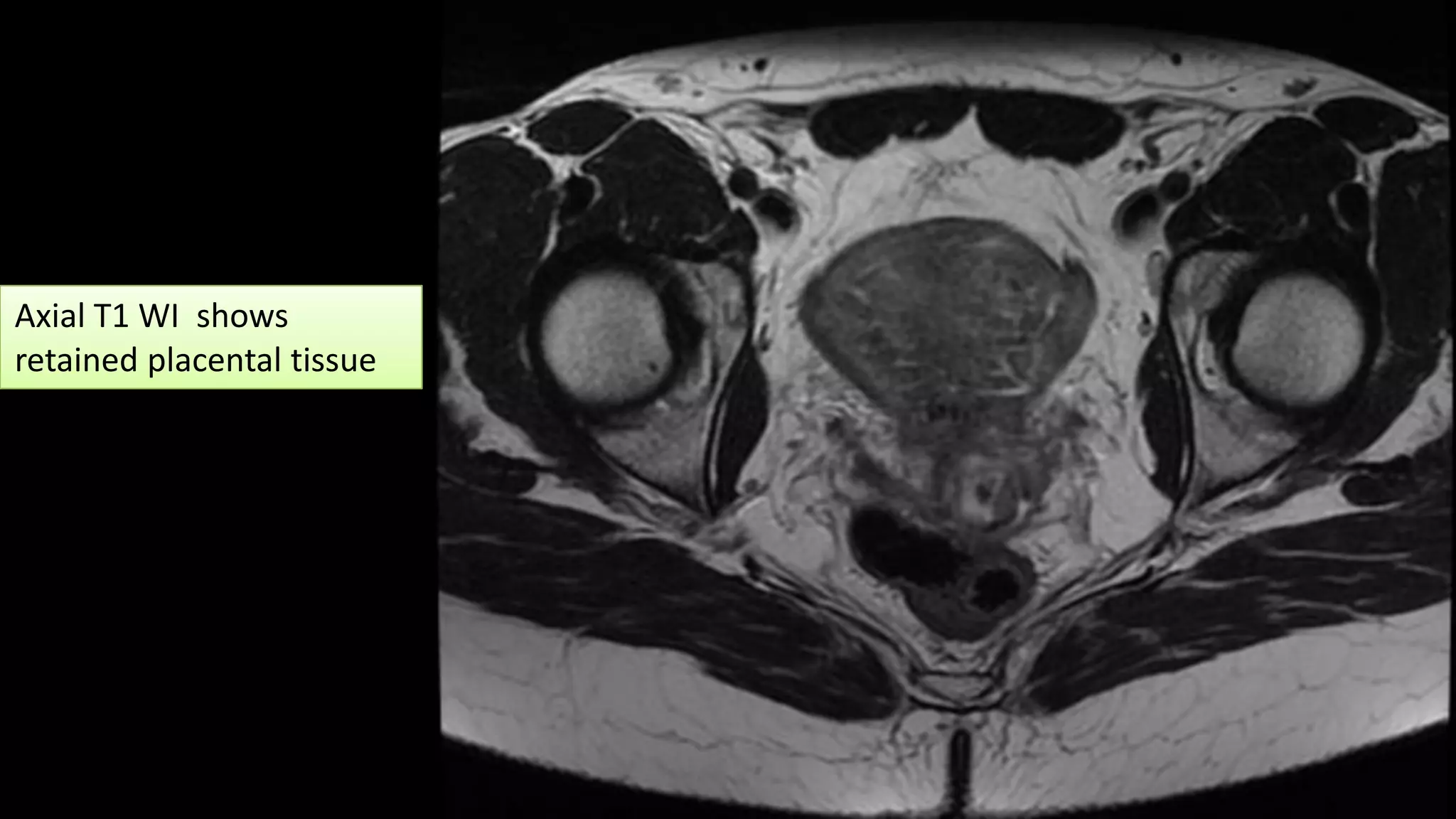 Retained products of conception dr.mohamed Soliman | PDF