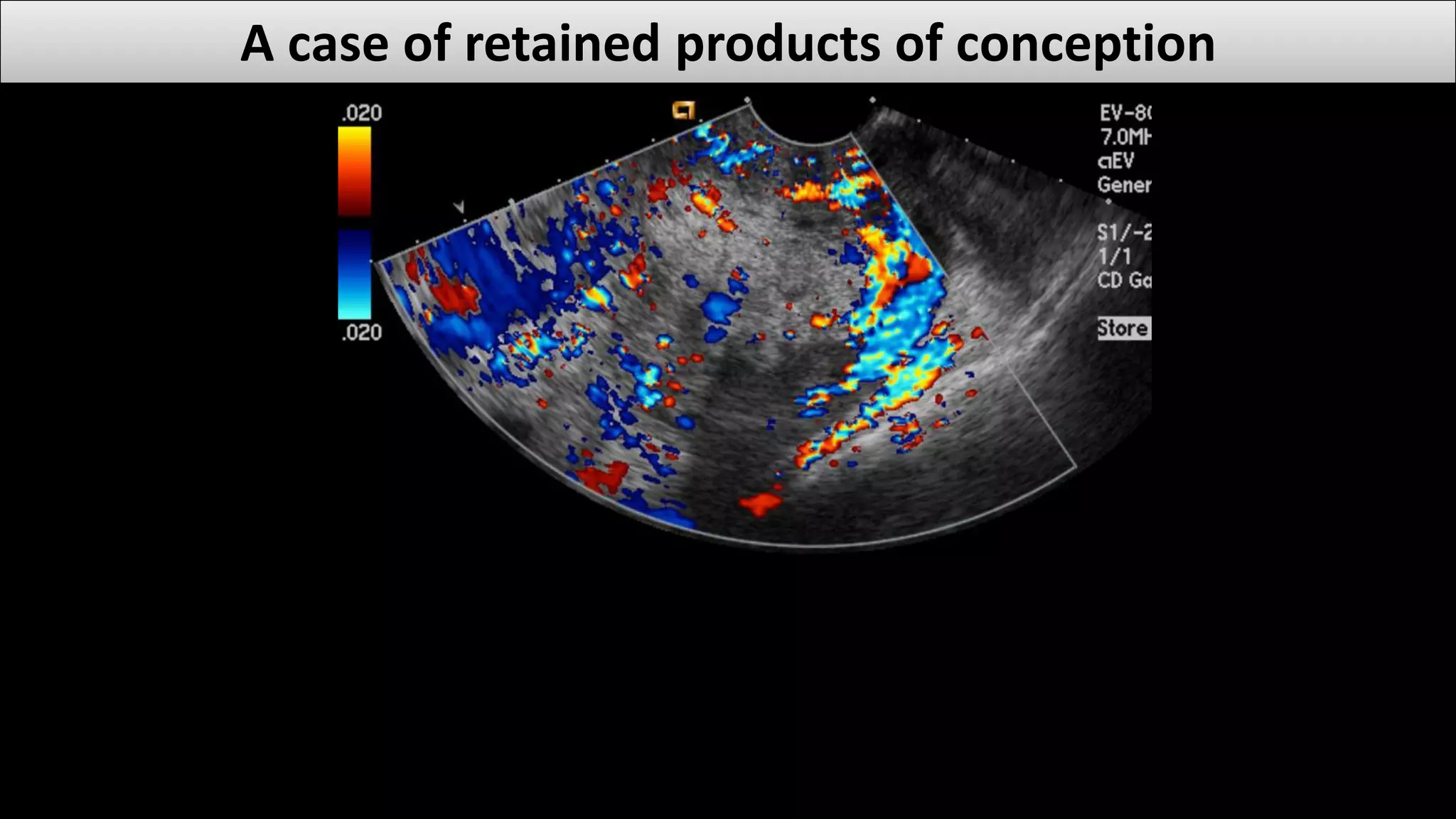 Retained products of conception dr.mohamed Soliman | PDF