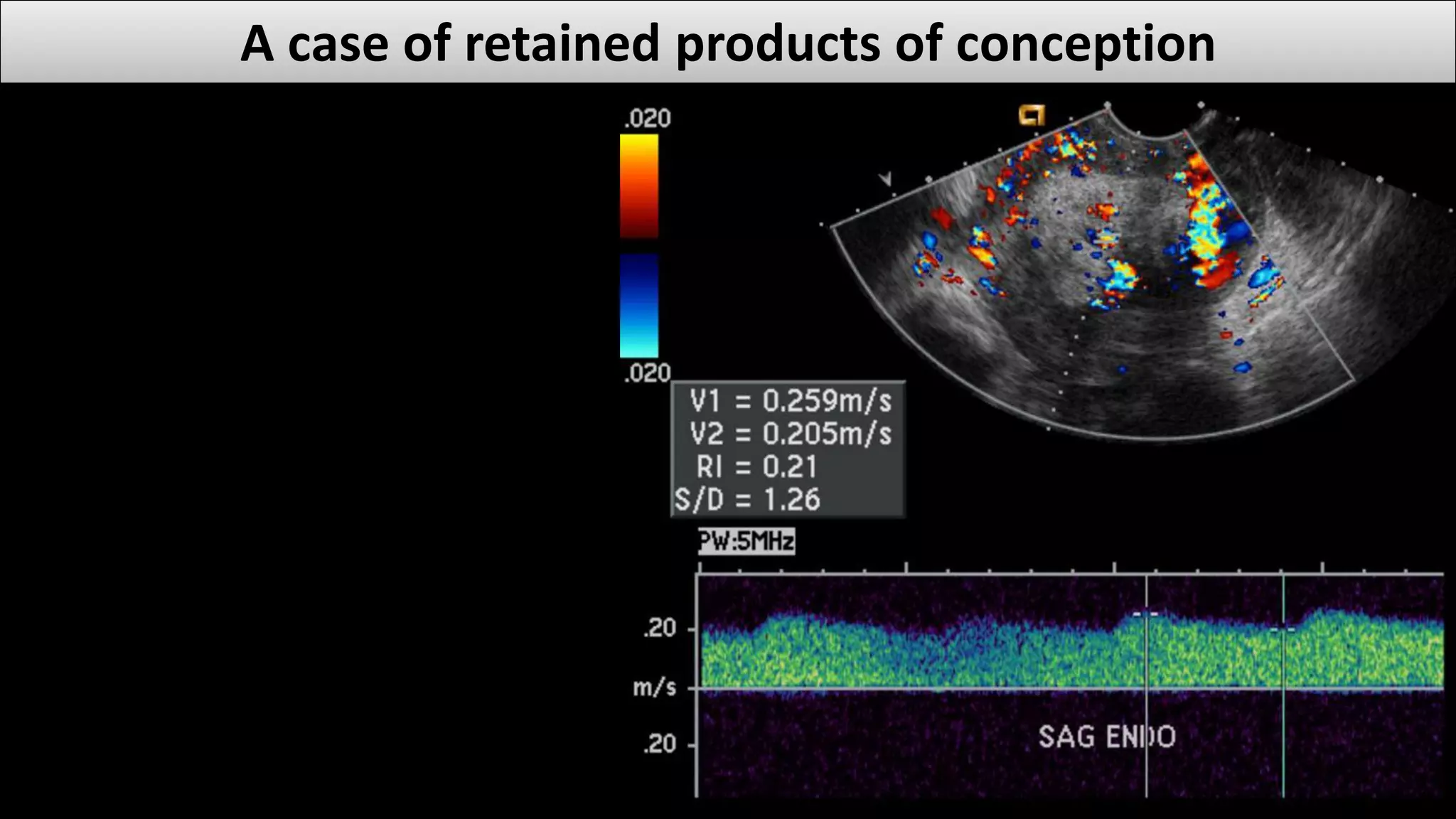 Retained products of conception dr.mohamed Soliman | PDF