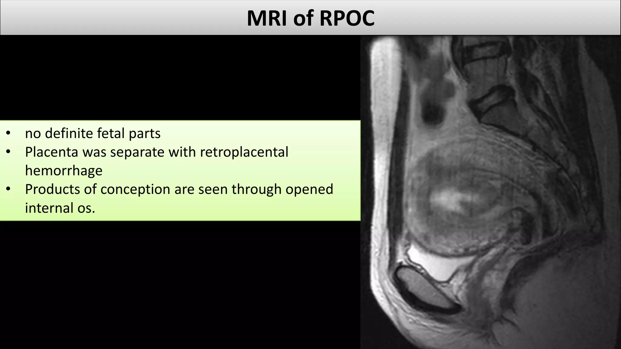 Retained products of conception dr.mohamed Soliman | PDF
