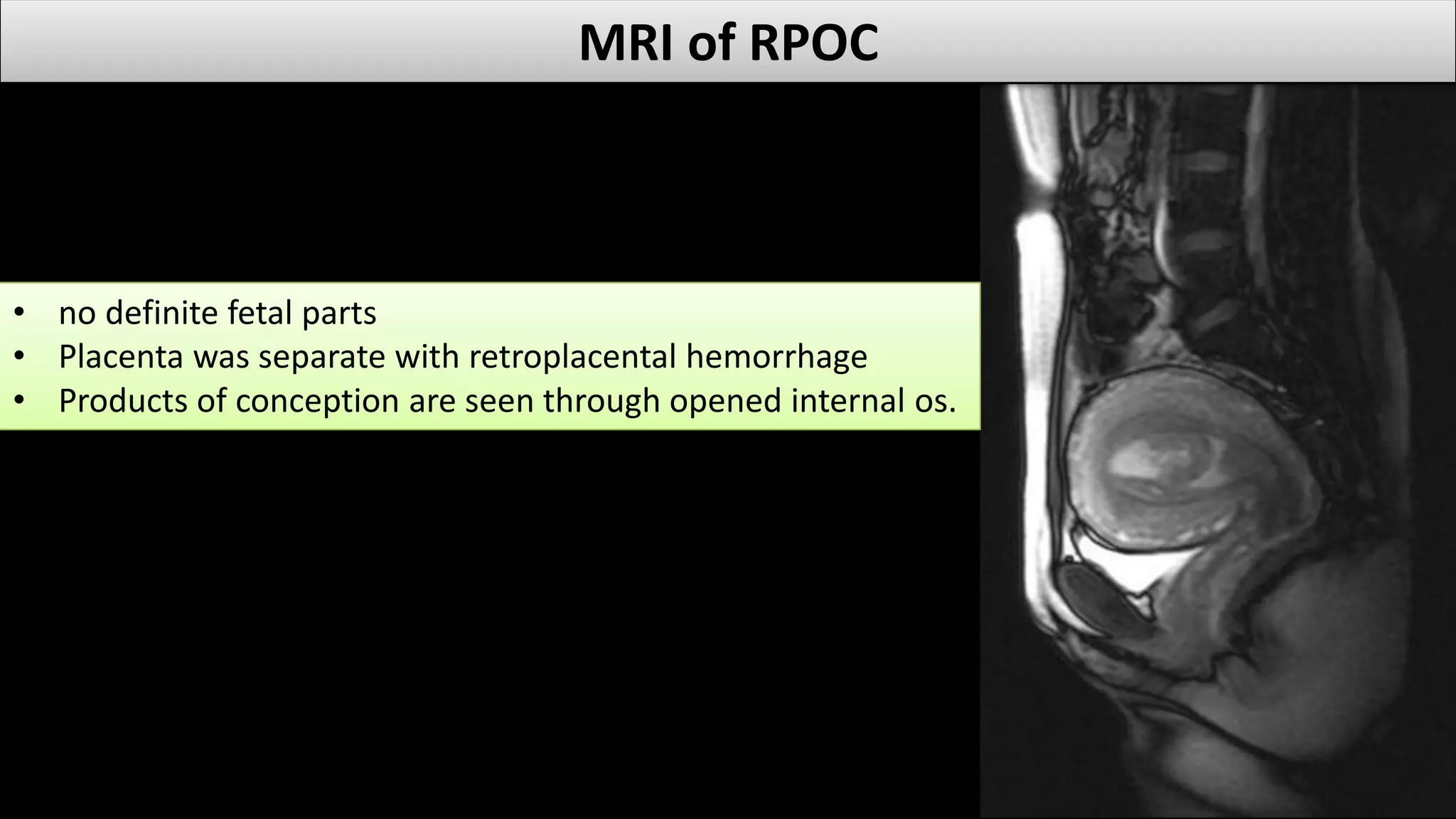 Retained products of conception dr.mohamed Soliman | PDF