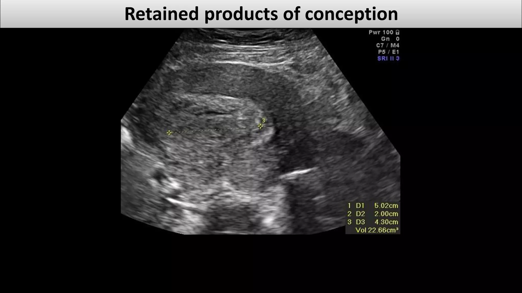 Retained products of conception dr.mohamed Soliman | PDF