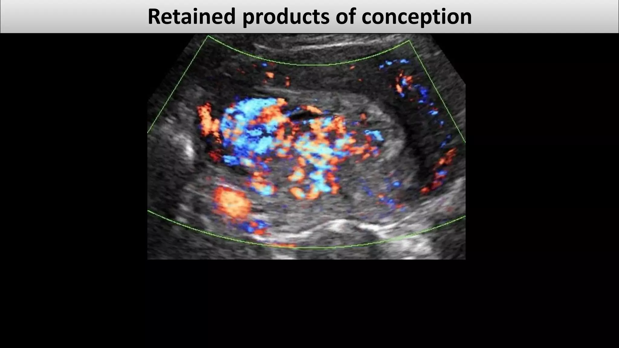 Retained products of conception dr.mohamed Soliman | PDF
