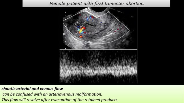 Retained products of conception dr.mohamed Soliman | PDF | Pregnancy ...