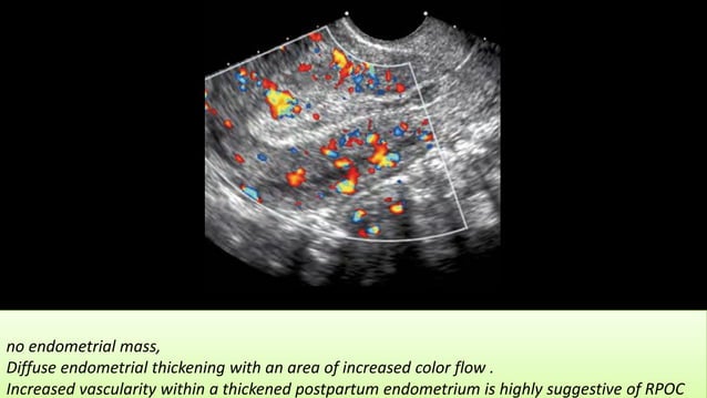 Retained products of conception dr.mohamed Soliman | PDF | Pregnancy ...