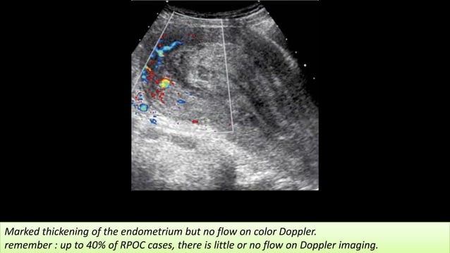 Retained products of conception dr.mohamed Soliman | PDF | Pregnancy ...
