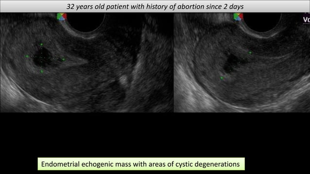 Retained products of conception dr.mohamed Soliman | PDF | Pregnancy ...