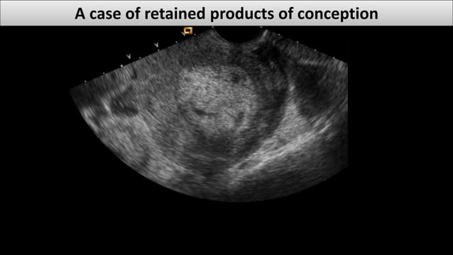 Retained products of conception dr.mohamed Soliman | PDF | Pregnancy ...