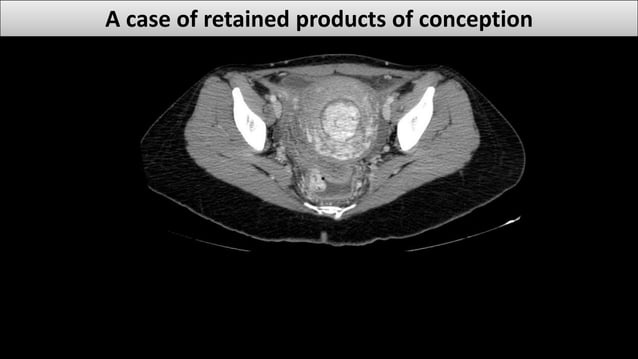 Retained products of conception dr.mohamed Soliman | PDF | Pregnancy ...