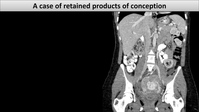 Retained products of conception dr.mohamed Soliman | PDF | Pregnancy ...