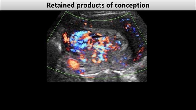 Retained products of conception dr.mohamed Soliman | PDF | Pregnancy ...