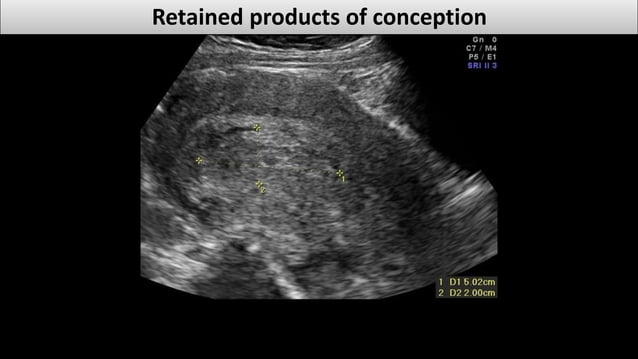 Retained products of conception dr.mohamed Soliman | PDF | Pregnancy ...