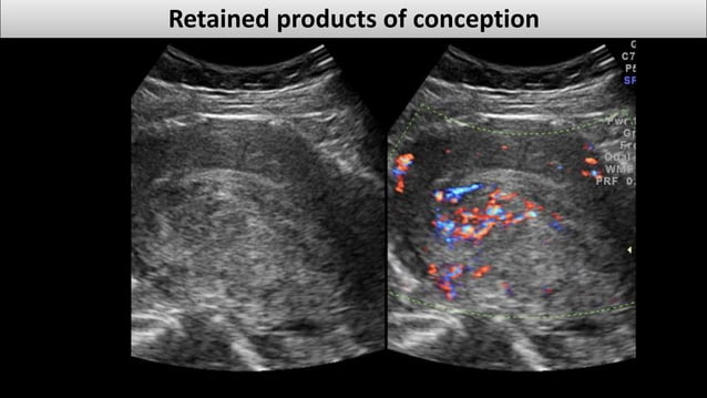 Retained products of conception dr.mohamed Soliman | PDF | Pregnancy ...