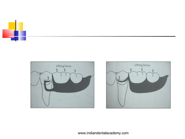 Retainers in RPD/ Labial orthodontics | PPT