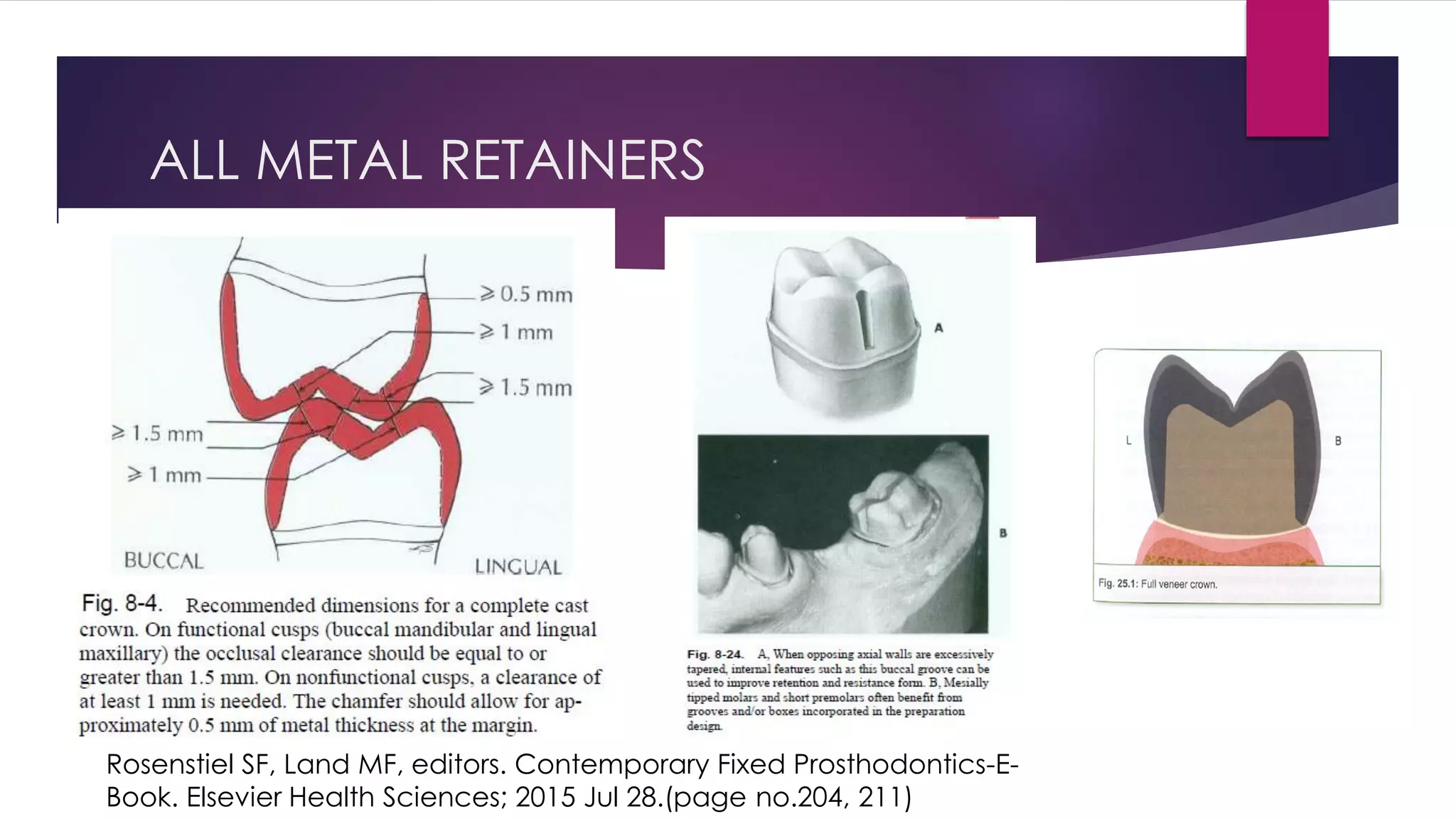 Retainers in FPD (FIXED PARTIAL DENTURES) PDF copy | PDF