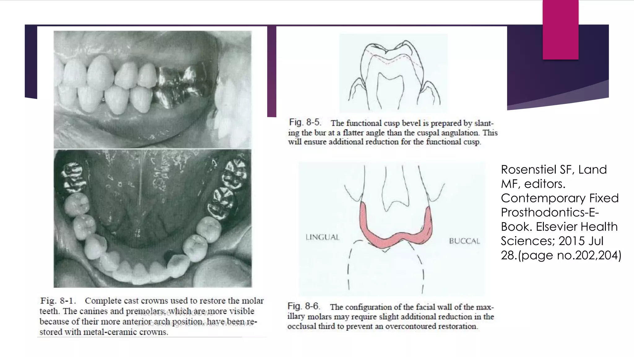 Retainers in FPD (FIXED PARTIAL DENTURES) PDF copy | PPT