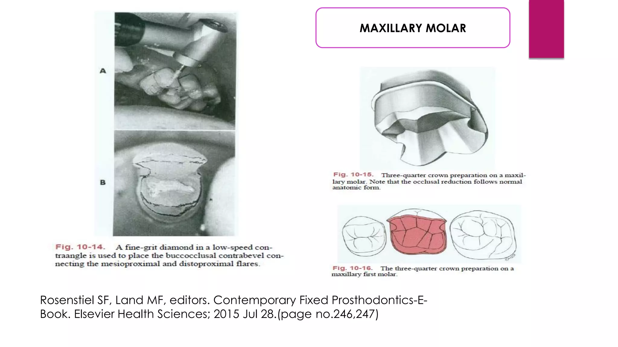 Retainers in FPD (FIXED PARTIAL DENTURES) PDF copy | PPT