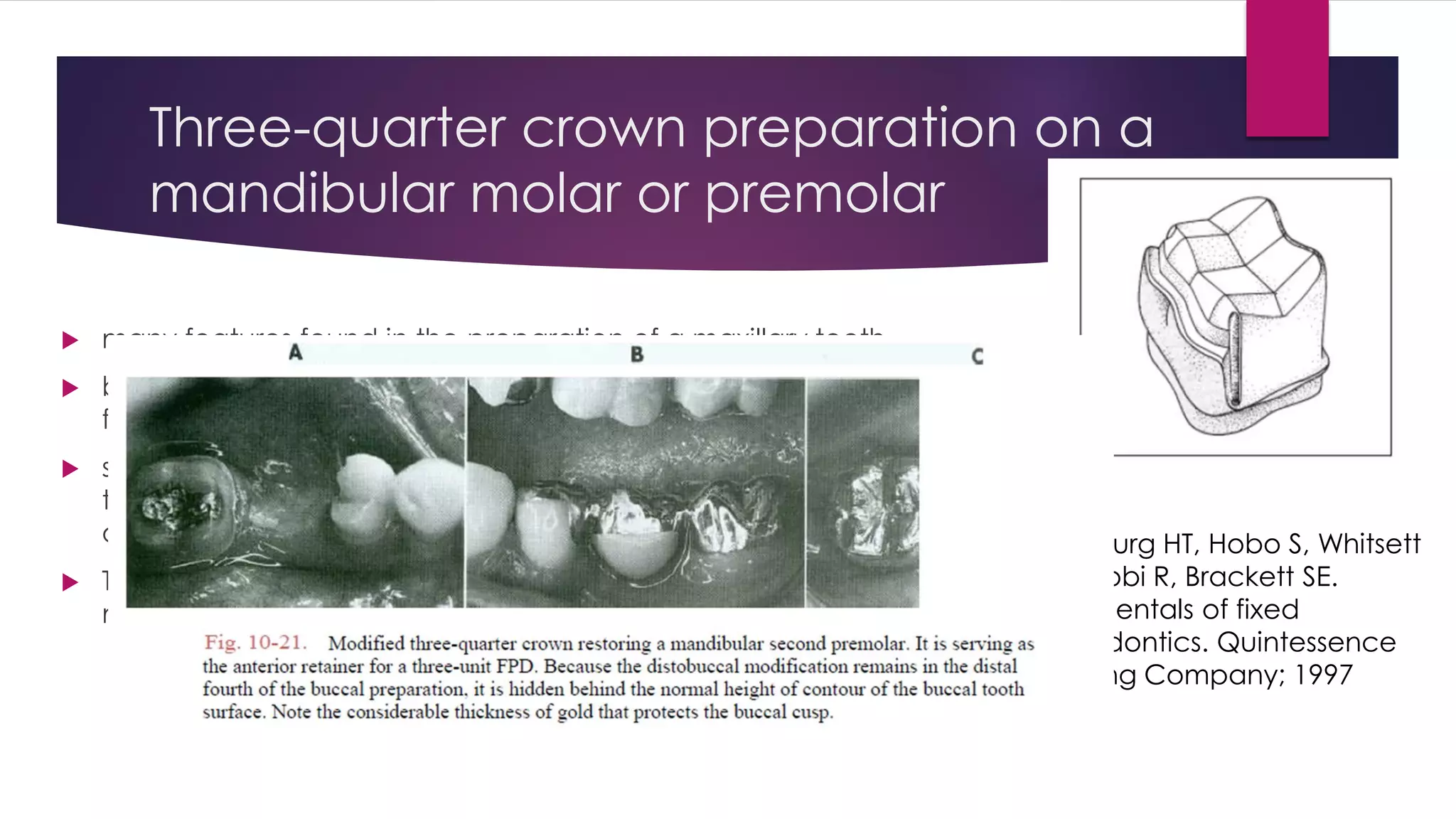Retainers in FPD (FIXED PARTIAL DENTURES) PDF copy | PDF