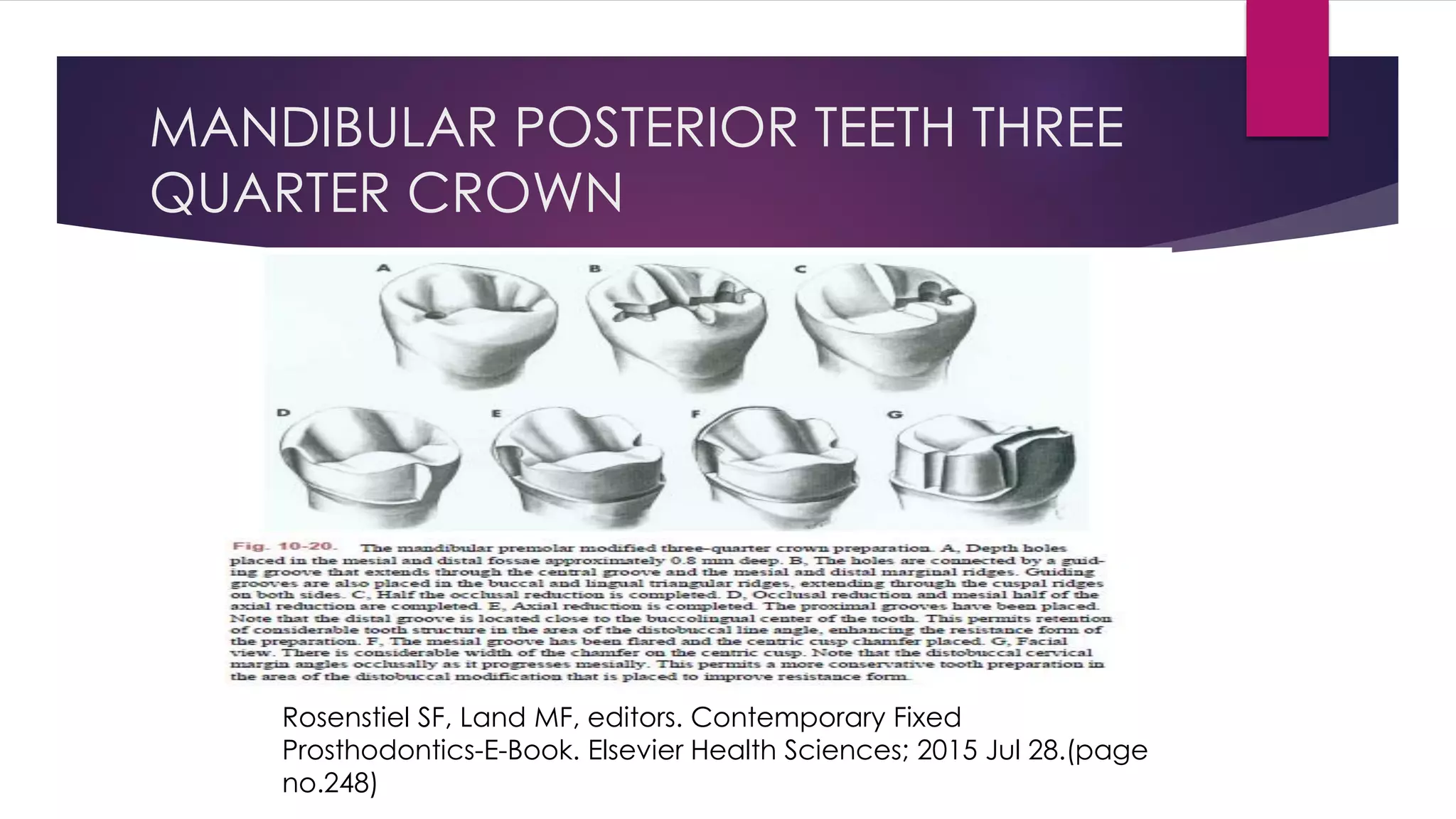 Retainers in FPD (FIXED PARTIAL DENTURES) PDF copy | PDF