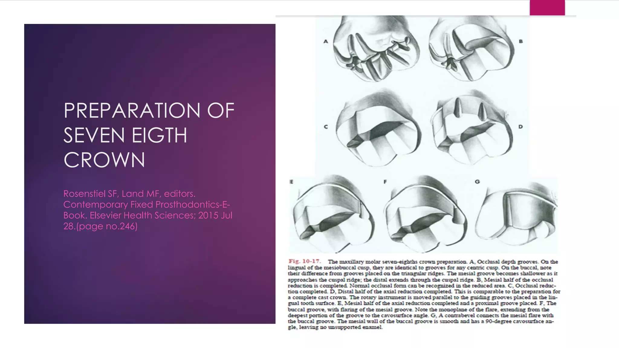 Retainers in FPD (FIXED PARTIAL DENTURES) PDF copy | PDF