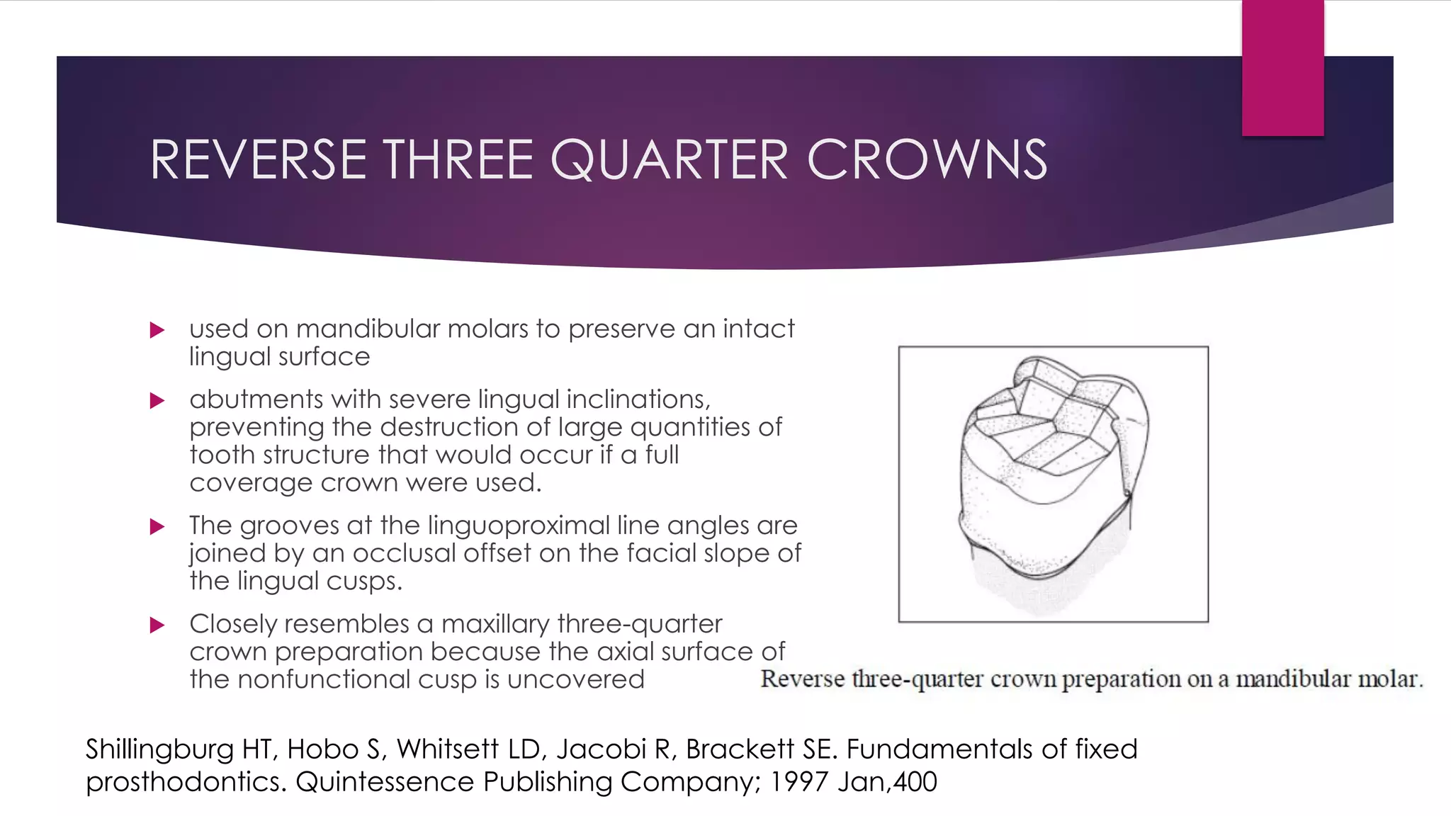 Retainers in FPD (FIXED PARTIAL DENTURES) PDF copy | PDF