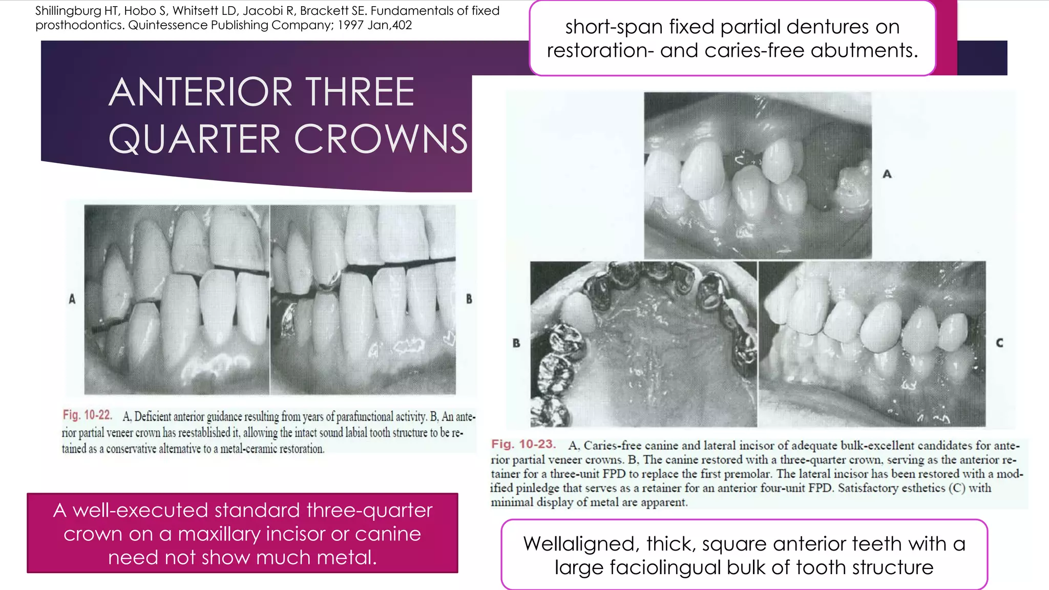 Retainers in FPD (FIXED PARTIAL DENTURES) PDF copy | PDF