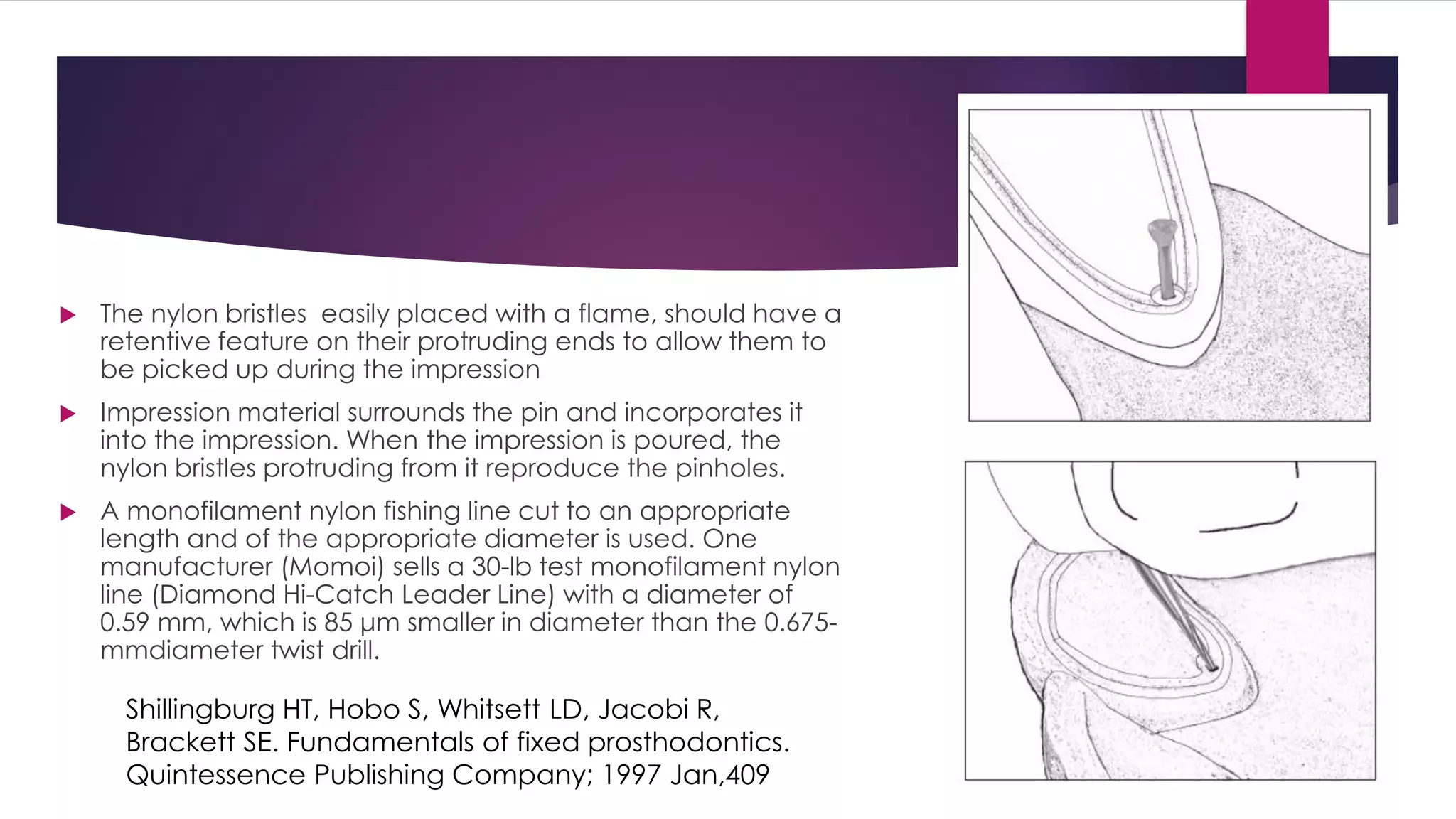Retainers in FPD (FIXED PARTIAL DENTURES) PDF copy | PDF